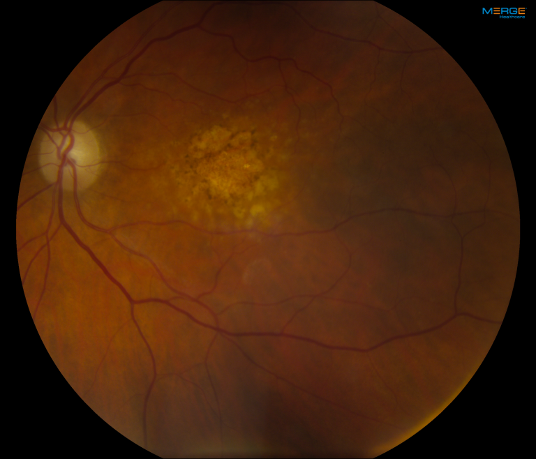 Age-Related Macular Degeneration—Dry and Wet – Retina Group of New England
